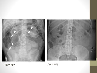 Abdominal x ray . axr | PPT