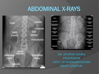 Abdominal X-RAYS- view , surgery point of view | PPTX