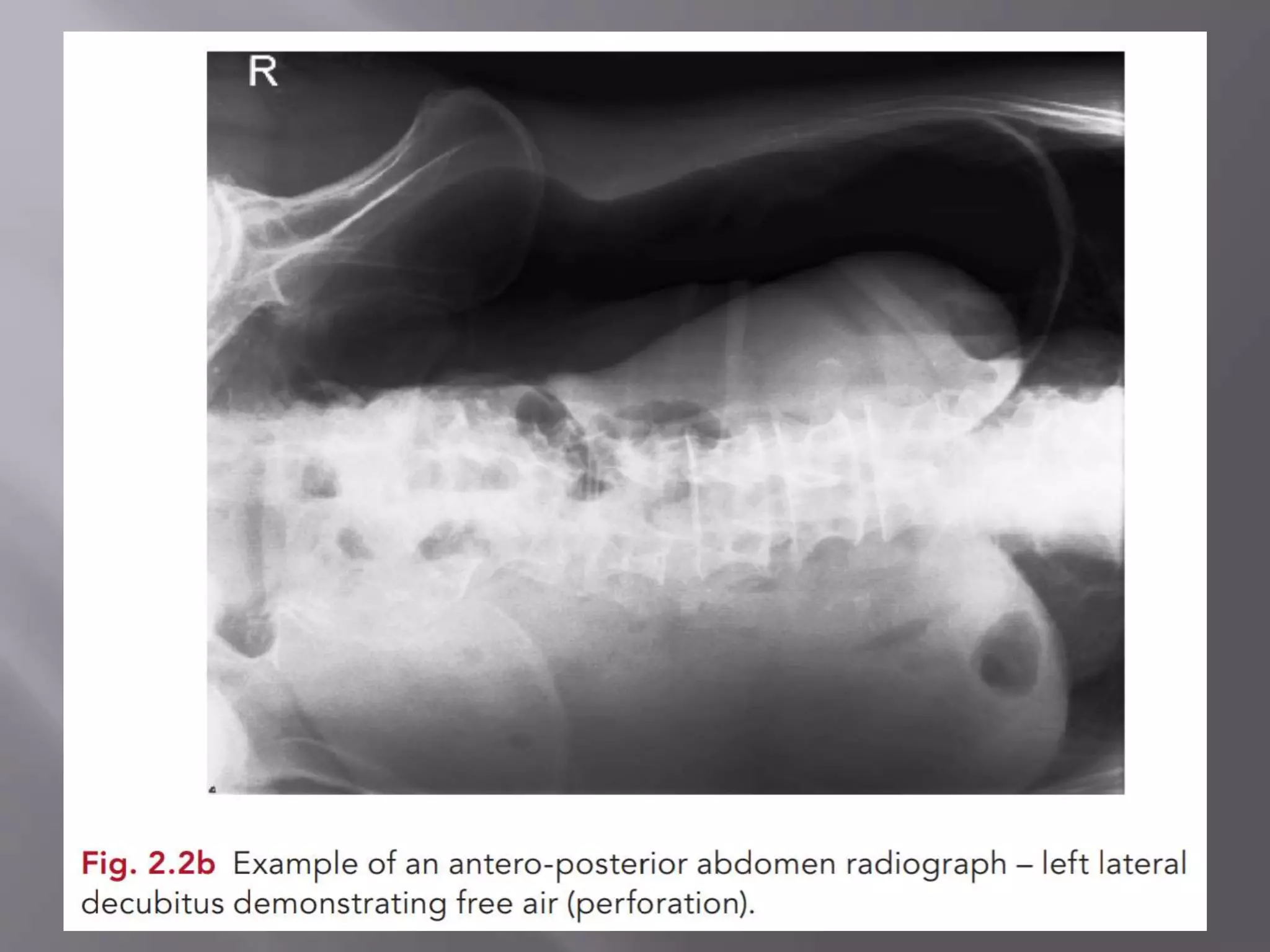 Abdominal x ray- views.pptx