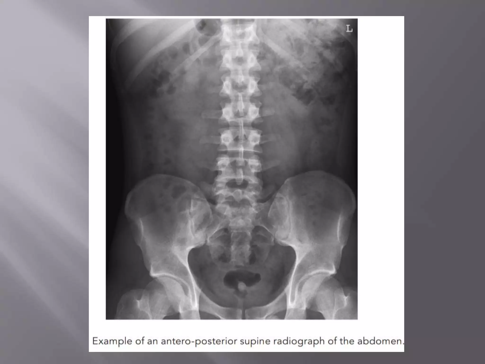 Abdominal x ray- views.pptx