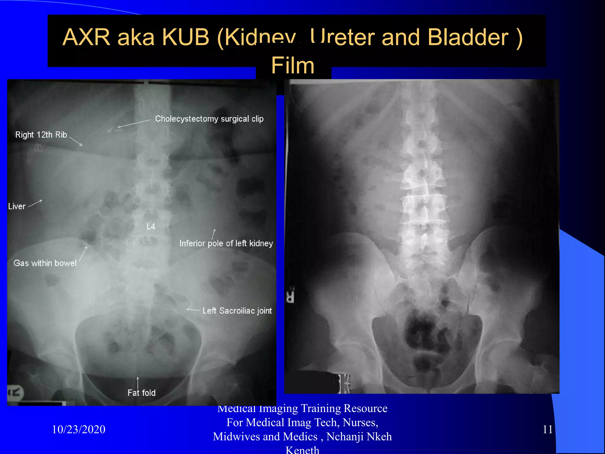 Abdominal x ray axr radiology training resource nchanji nkeh keneth | PDF
