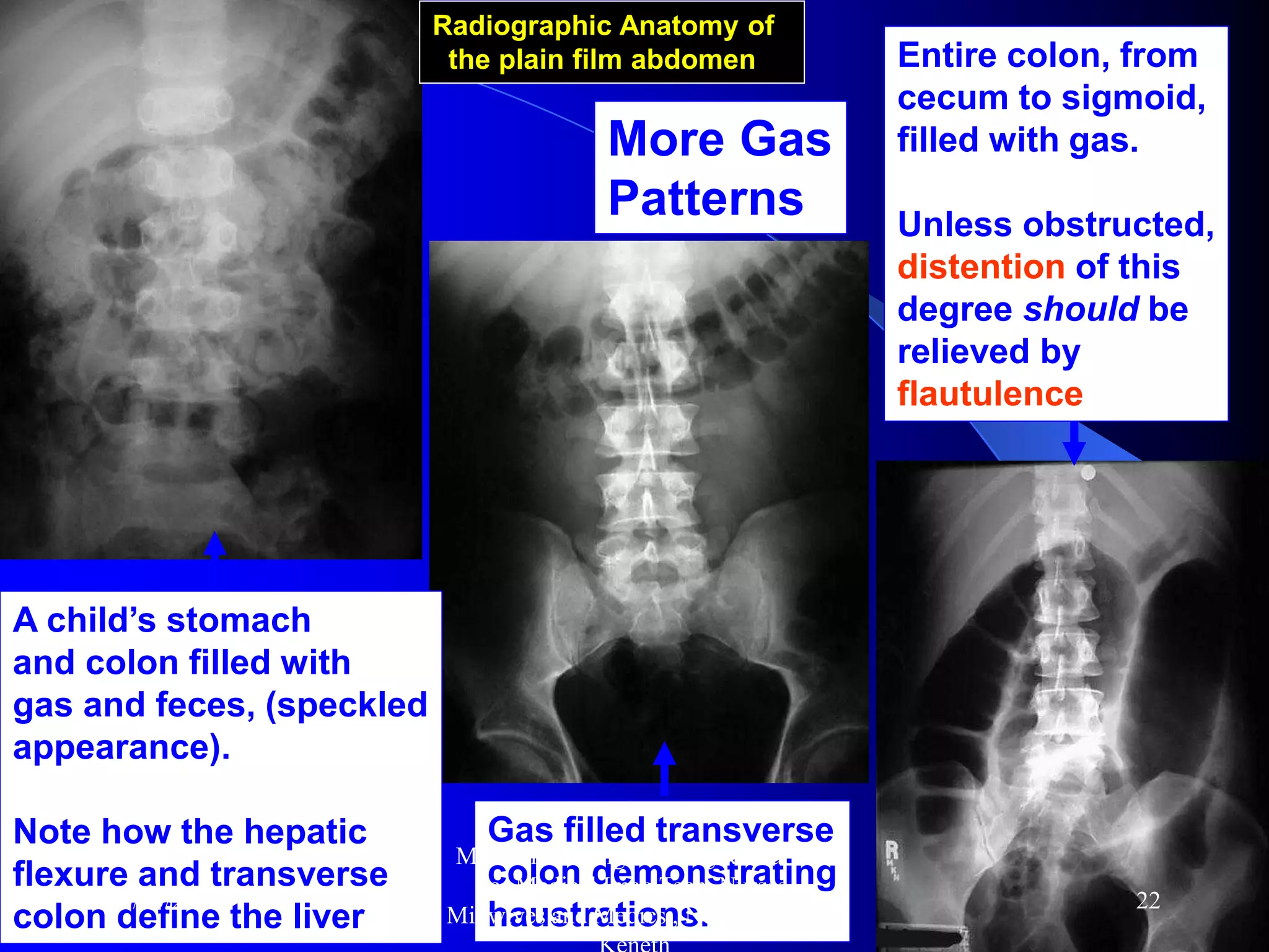 Abdominal x ray axr radiology training resource nchanji nkeh keneth | PDF