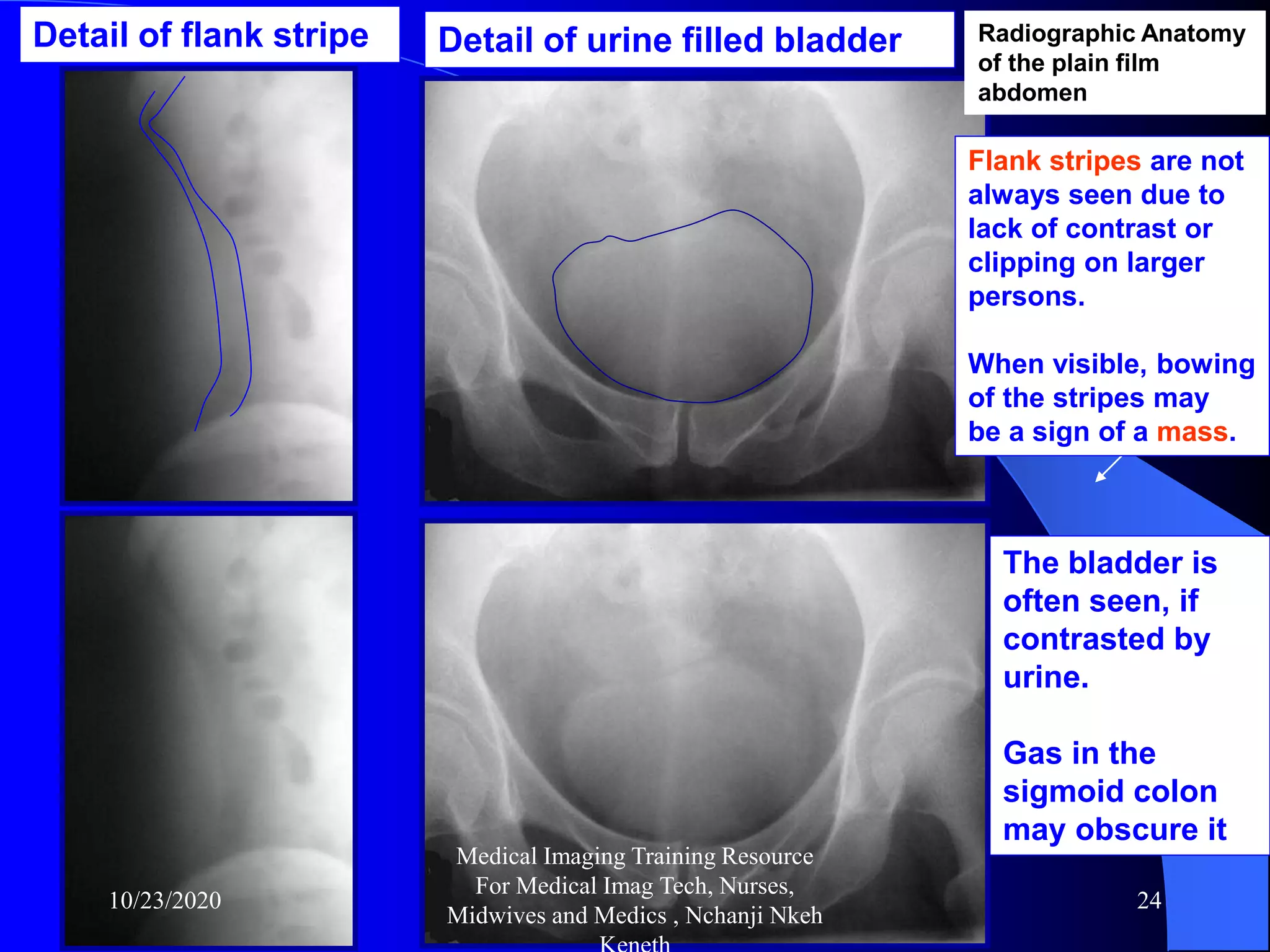 Abdominal x ray axr radiology training resource nchanji nkeh keneth | PDF