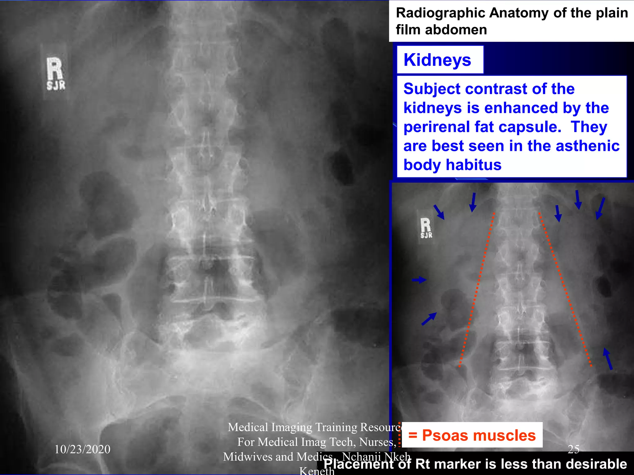 Abdominal x ray axr radiology training resource nchanji nkeh keneth | PDF
