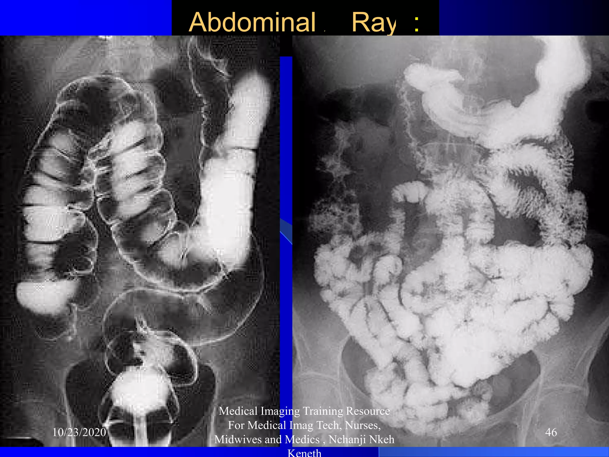 Abdominal x ray axr radiology training resource nchanji nkeh keneth | PDF