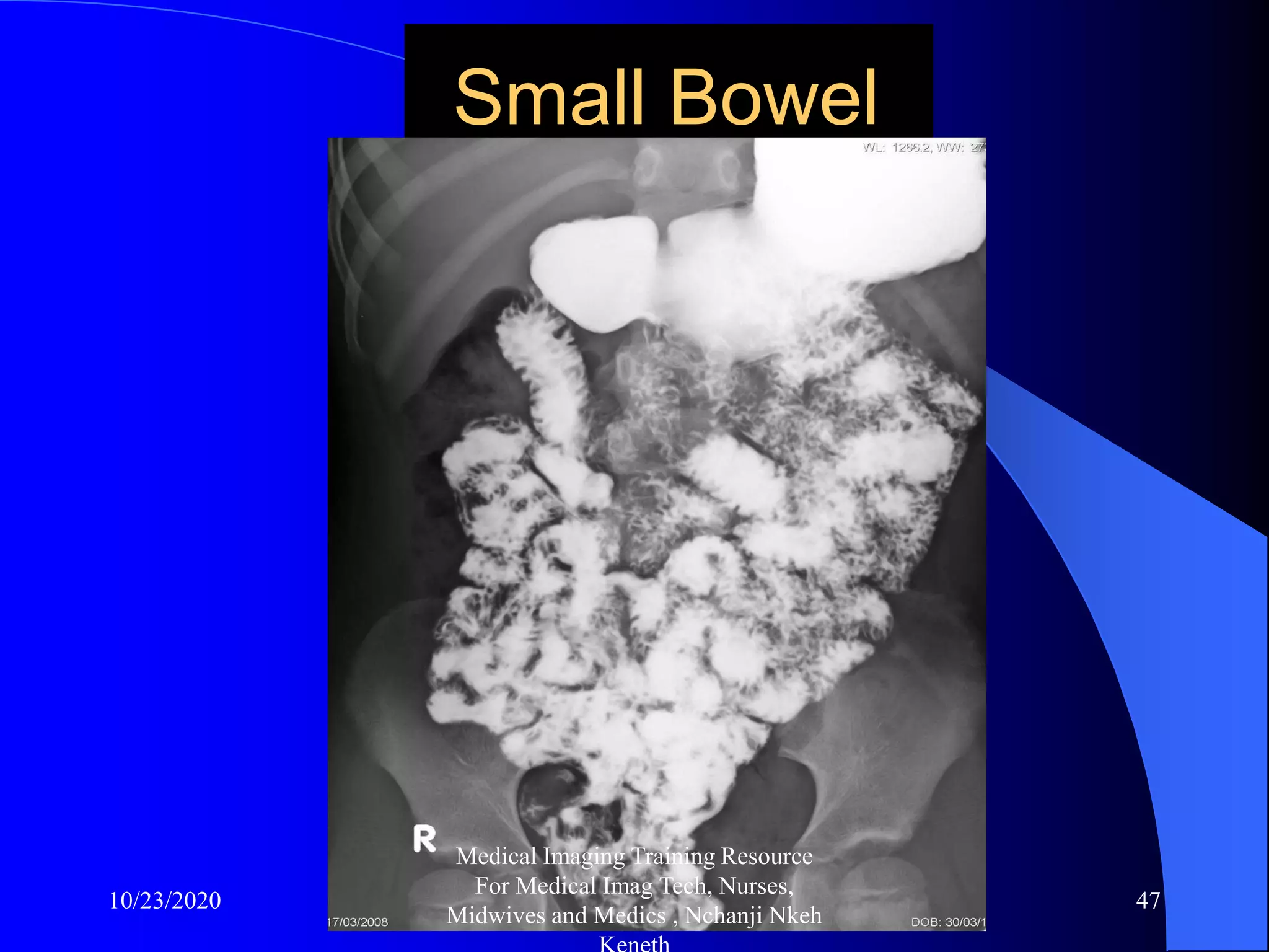Abdominal x ray axr radiology training resource nchanji nkeh keneth | PDF