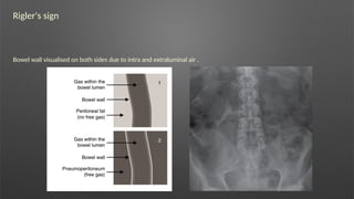 Abdominal xray RADIOLOGY final.pptx .pptx