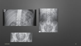 Abdominal xray RADIOLOGY final.pptx .pptx