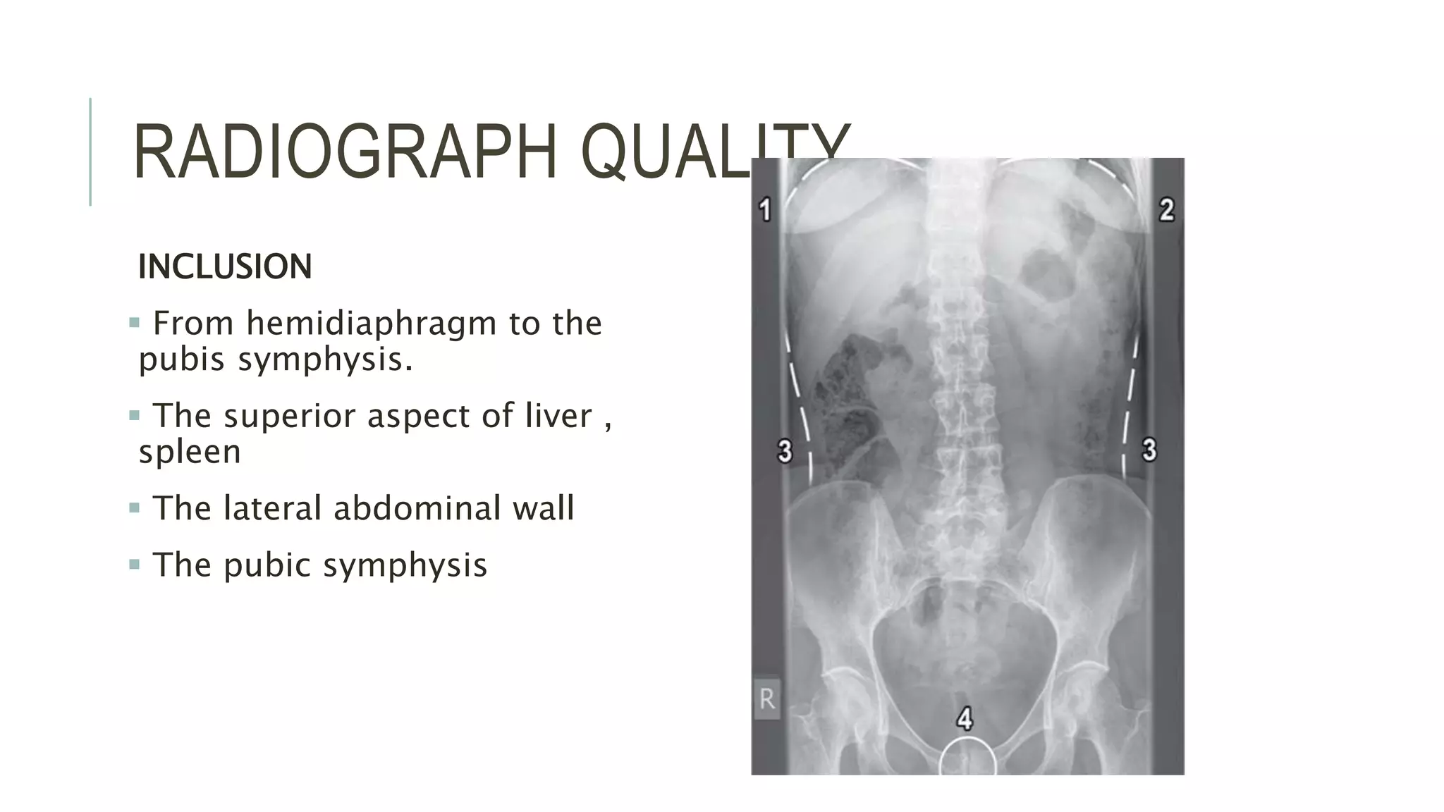 Abdominal xray - imaging and interpretation | PPTX