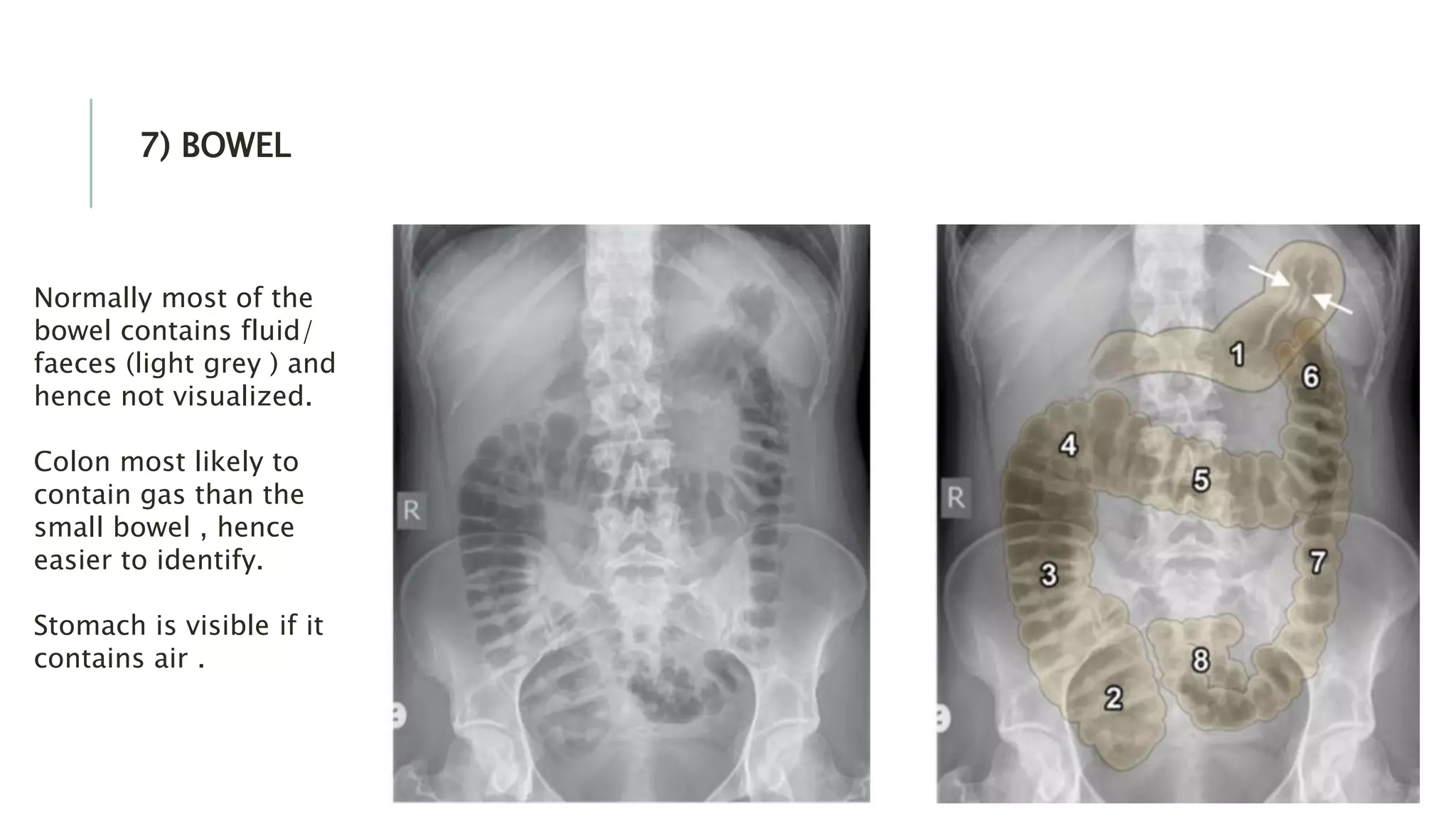 Abdominal xray - imaging and interpretation | PPTX