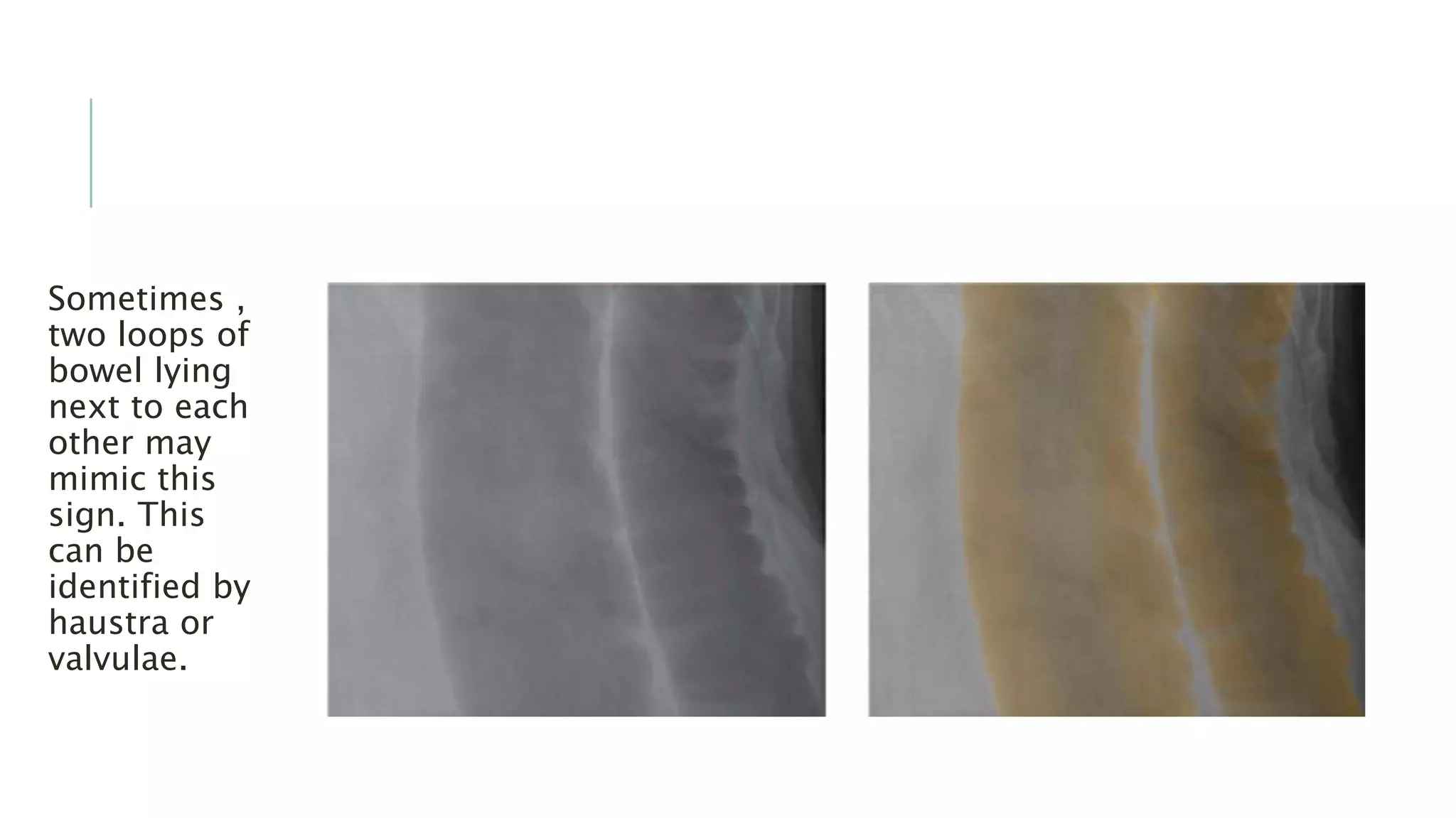 Abdominal xray - imaging and interpretation | PPTX