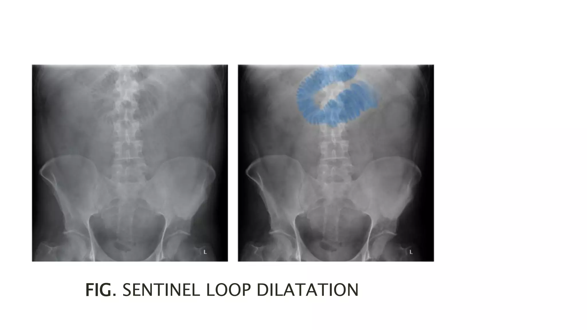 Abdominal xray - imaging and interpretation | PPTX