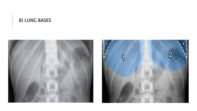 Abdominal xray - imaging and interpretation | PPTX