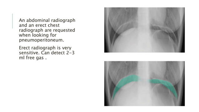 Abdominal xray - imaging and interpretation | PPTX