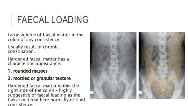 Abdominal xray - imaging and interpretation
