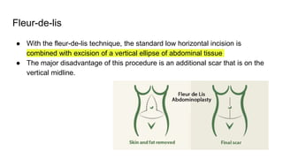 Anatomy of Abdominal wall and Abdominoplasty | PPTX