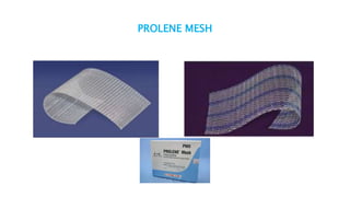 Abdoninal hernia | PPTX