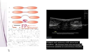 abdo wall of human male and femalehernia.pptx