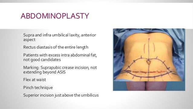 Abdominoplasty - Dr Mujtuba Pervez Khan