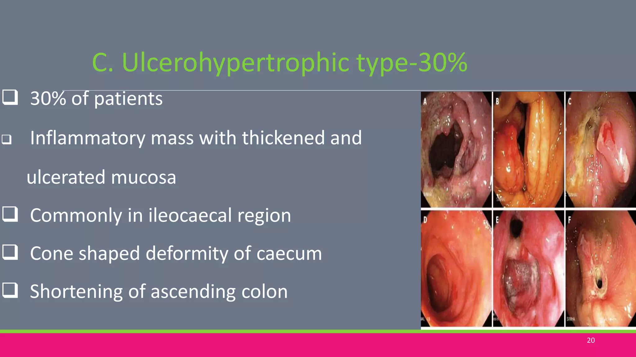Abdominal Tuberculosis | PPT