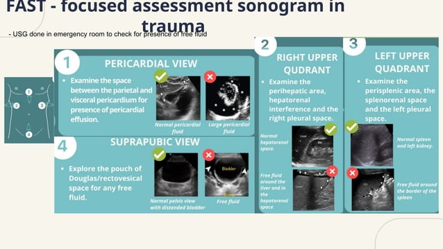 abdominal trauma basics, diagnosis, treatment, organ wise ...