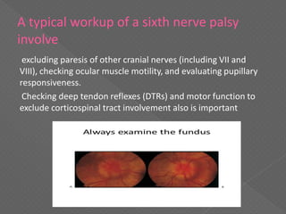 6 th nerve palsy | PPT
