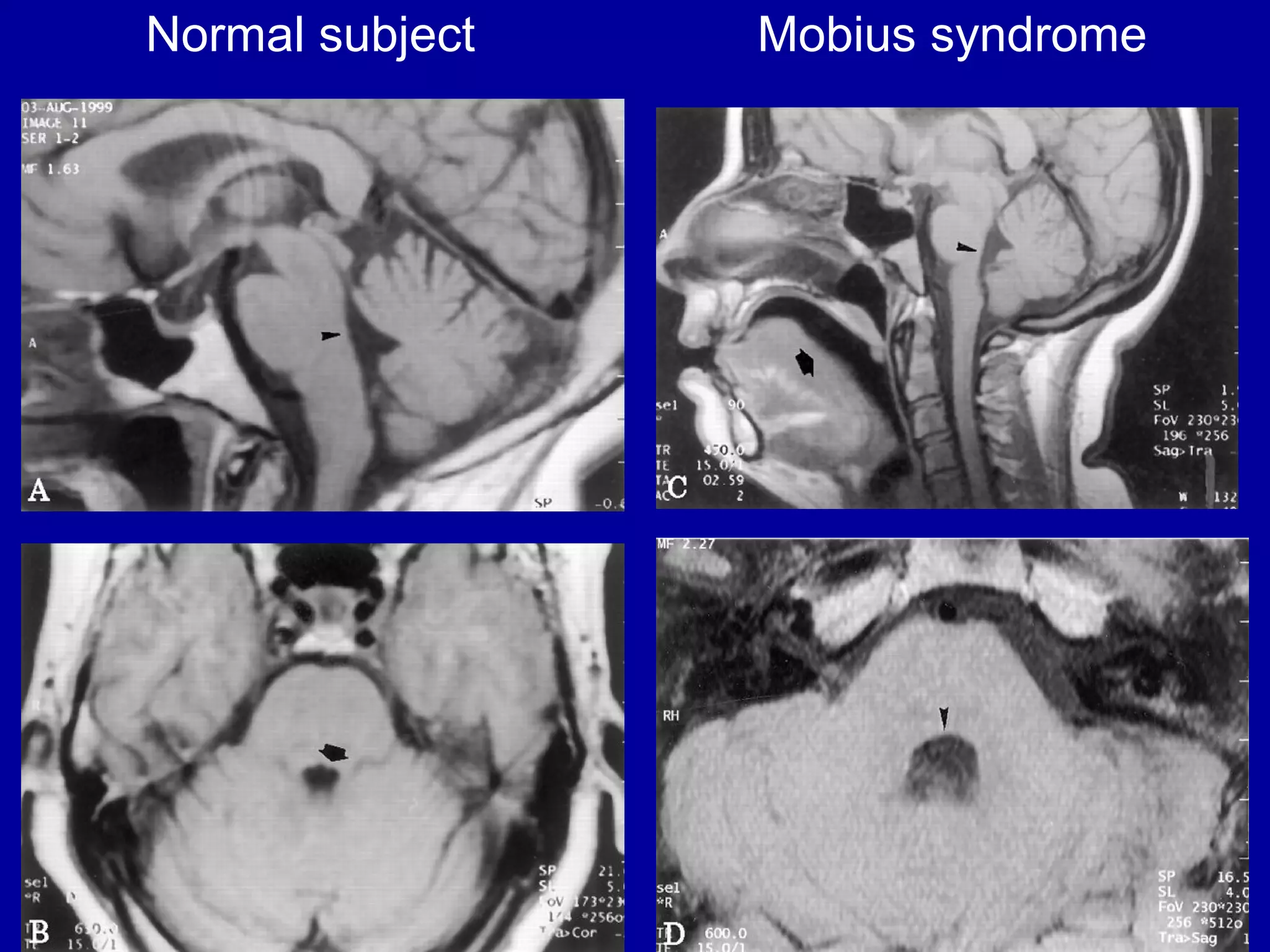 Abducent nerve | PPT