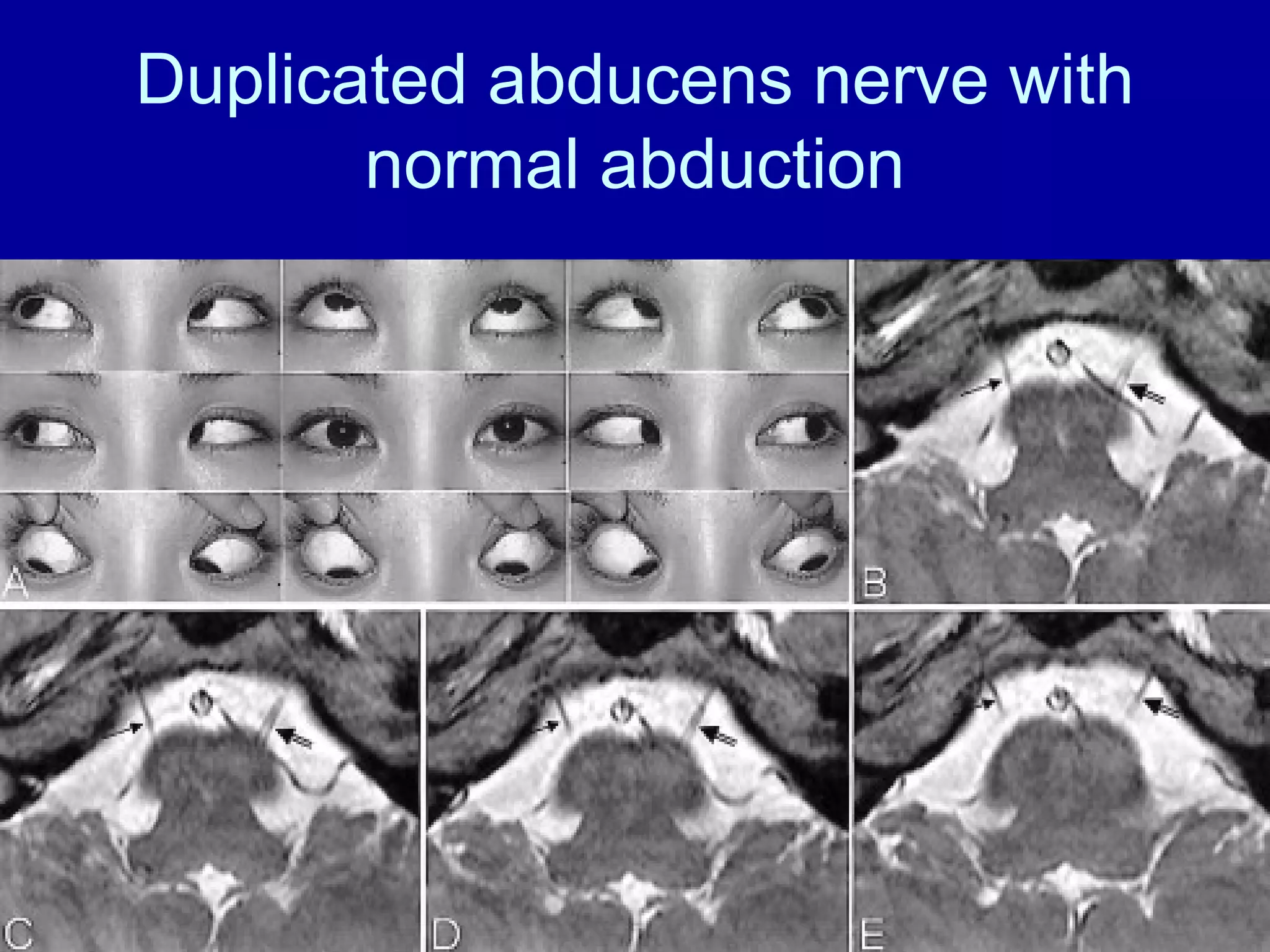 Abducent nerve | PPT