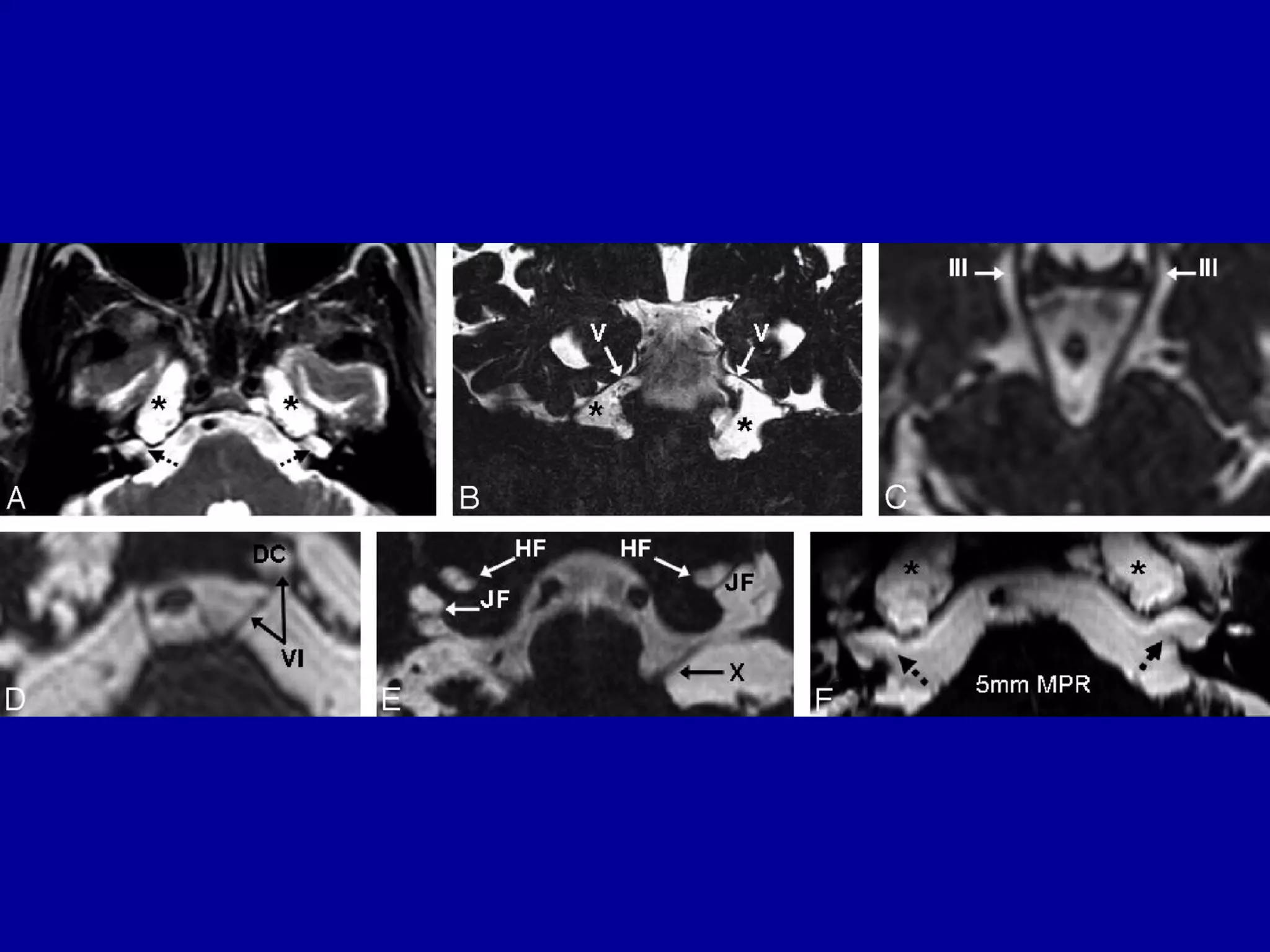 Abducent nerve | PPT