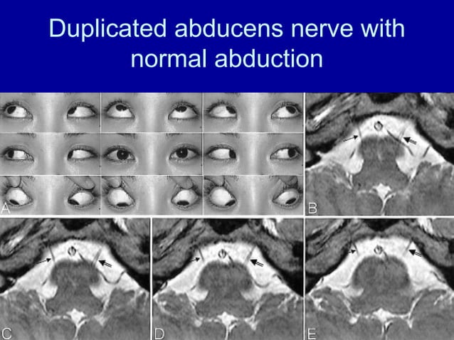 Abducent nerve | PPT