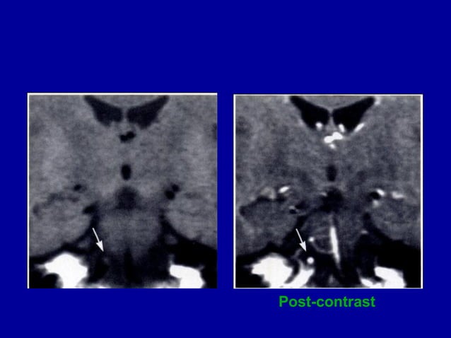 Abducent nerve | PPT