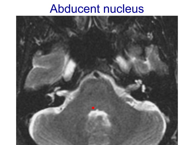 Abducent nerve | PPT
