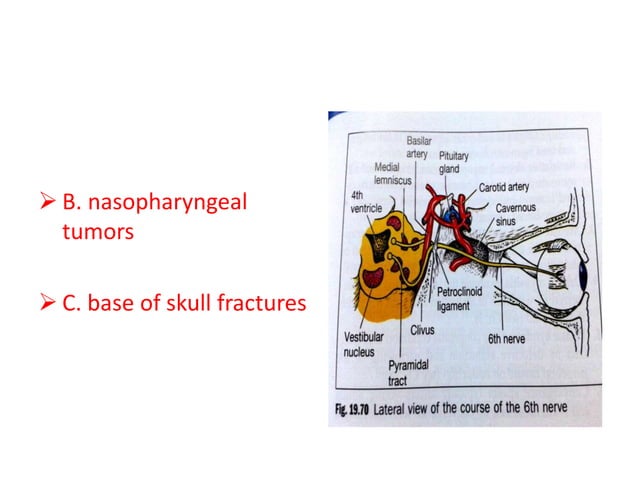 Abducent nerve dnm | PPTX | Ear, Nose and Throat Conditions | Diseases ...