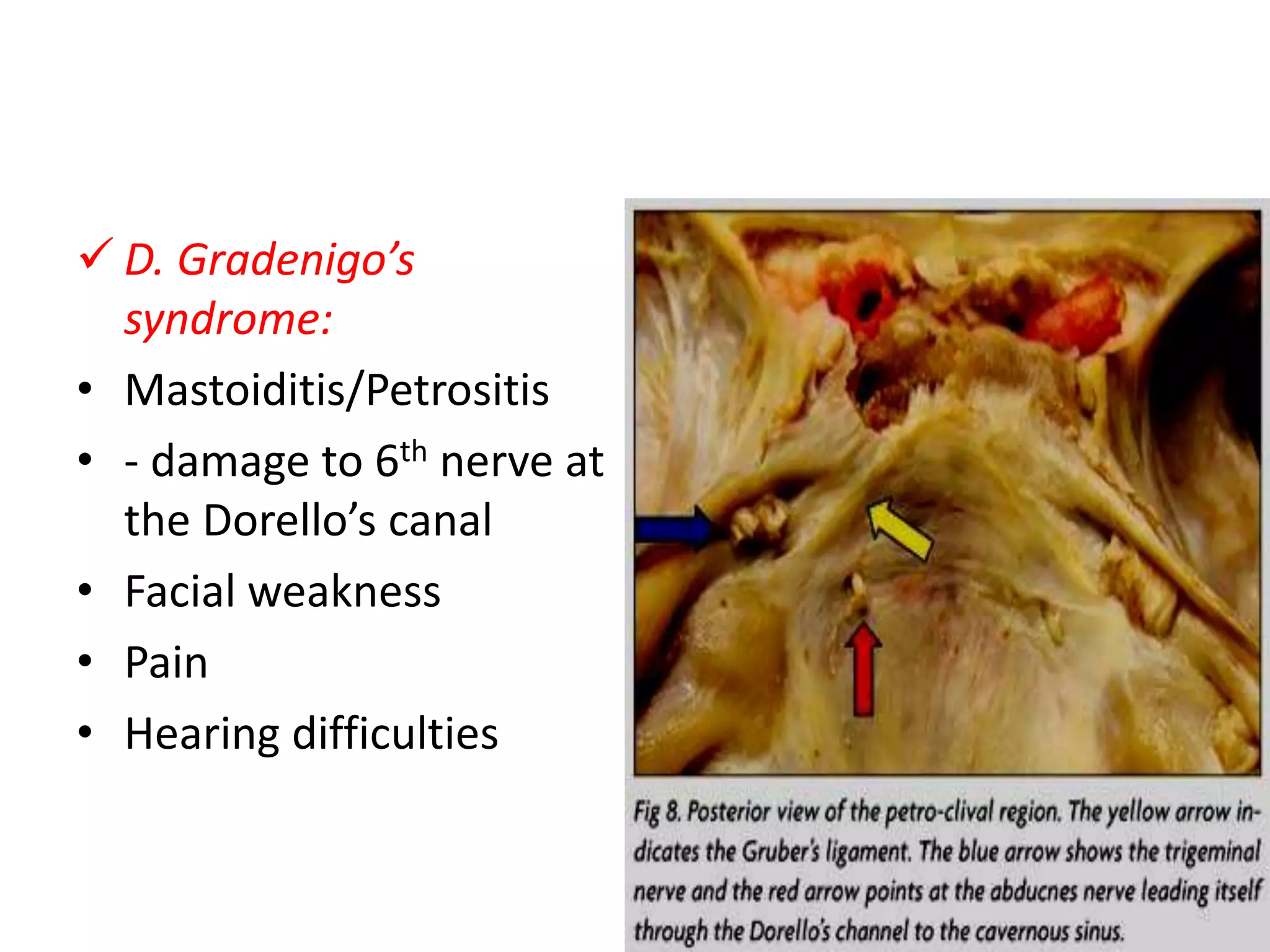Abducent nerve clinical anatomy | PPTX