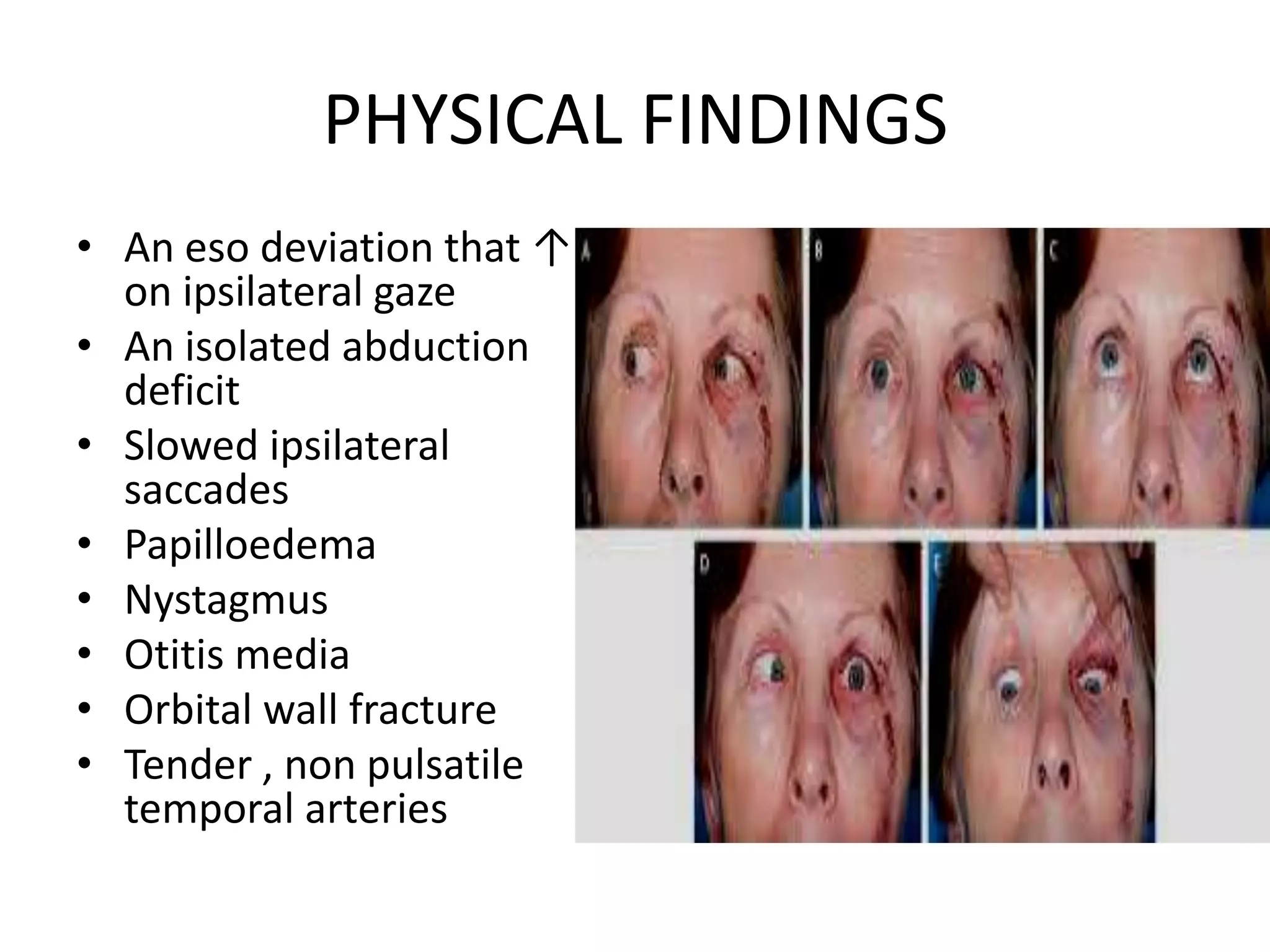 Abducent nerve clinical anatomy | PPTX