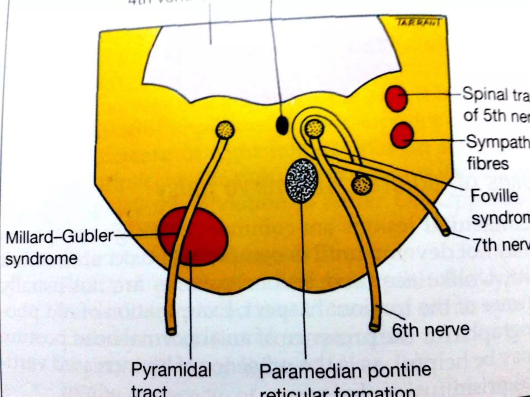 Abducent nerve clinical anatomy | PPTX
