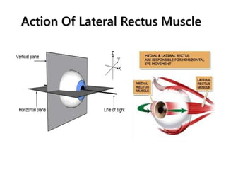 Abducent nerve palsy | ODP