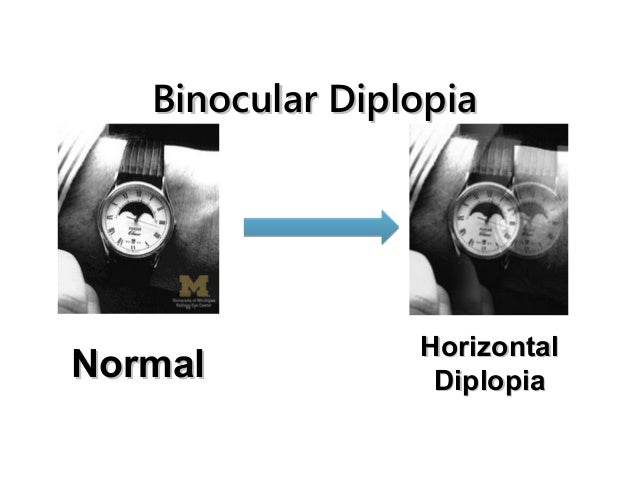Binocular diplopia causes - molipower