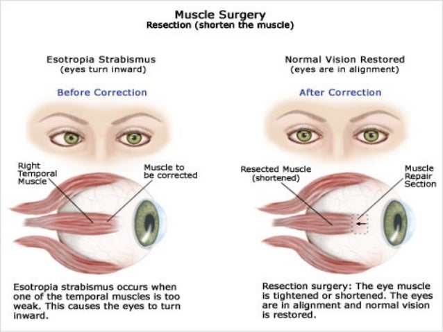 Abducent Nerve Palsy