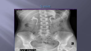 intravenous pyelogram (IVP) . abdul hakeem and atif iqbal .ppt