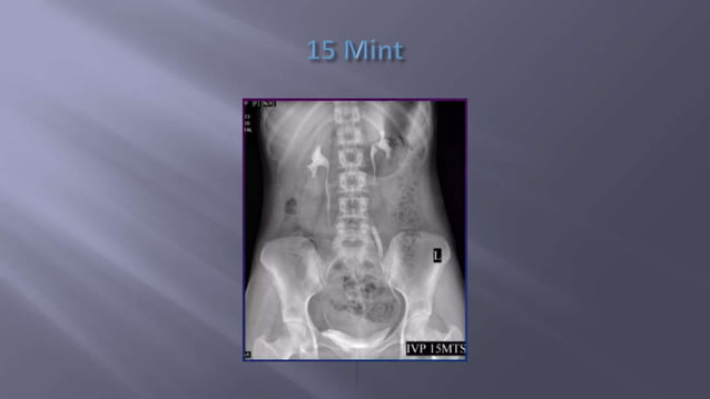 intravenous pyelogram (IVP) . abdul hakeem and atif iqbal .ppt