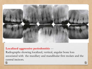 Abdullah .radiographic-aids-in-the-diagnosis-of-periodontal-diseases.pptx