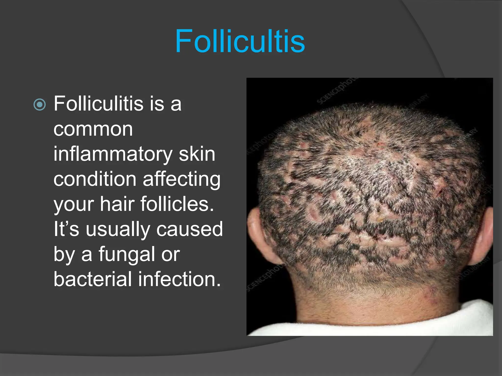 Scalp infection and its complications.pptx | Skin and Dermatology ...