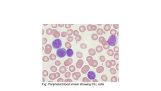Lymphoma, Chronic lymphocytic lymphoma, small lymphocytic lymphoma | PPTX