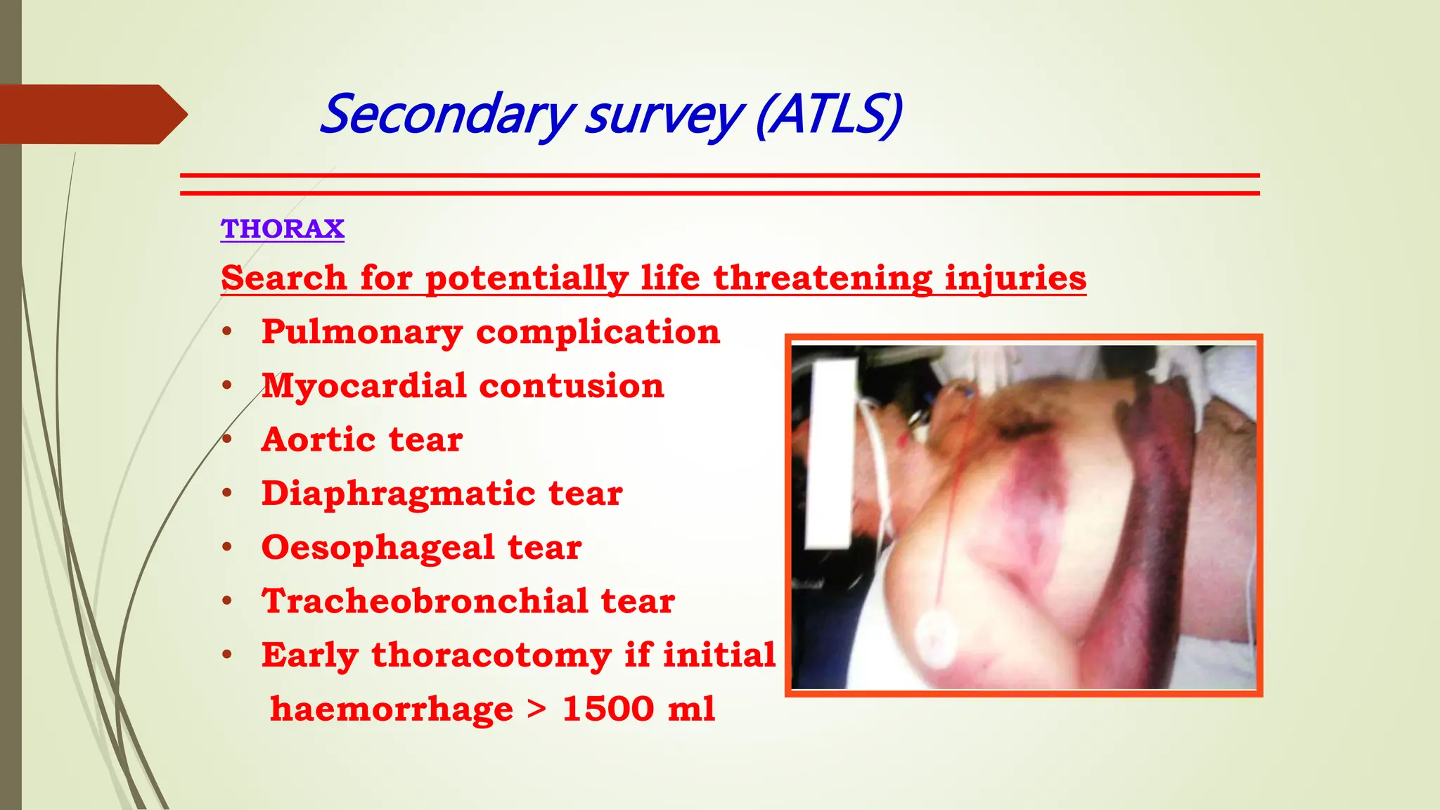 Multiple trauma and it’s definition , classification | PPTX