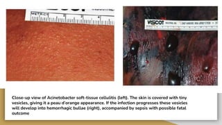 Infectious complications of combat injuries | PPTX