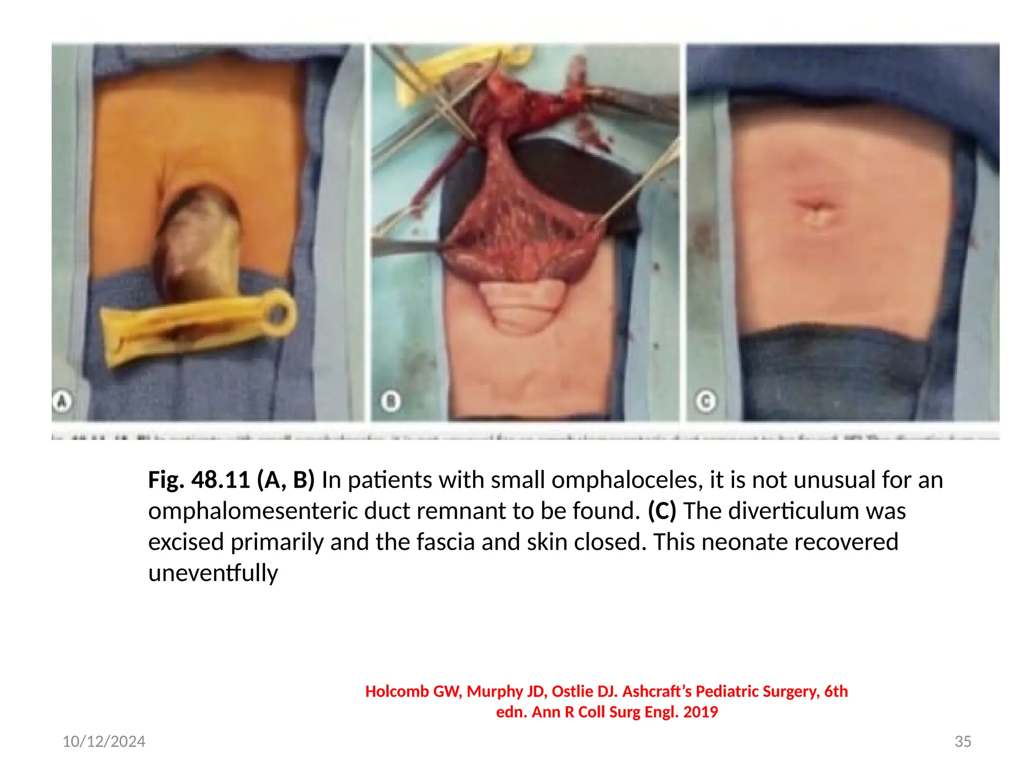 Gastroschisis and omphalocele ; congenital abdominal wall defects | PPT