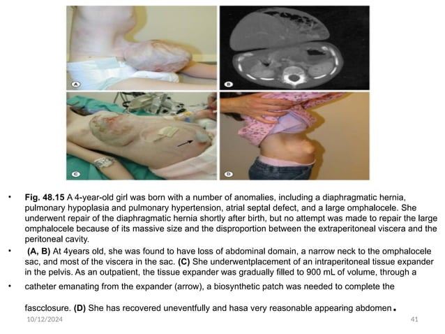Gastroschisis and omphalocele ; congenital abdominal wall defects | PPT