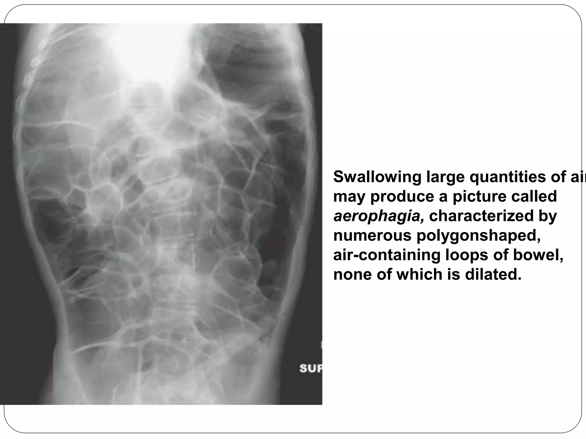 abdominal x ray radiology | PPTX