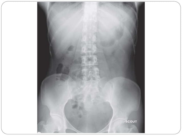 abdominal x ray radiology | PPTX